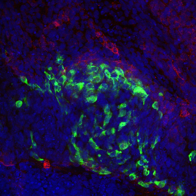 Cellule staminali pluripotenti per trattare il diabete di tipo 1: primo studio nell’ uomo in ...